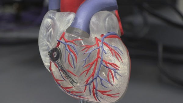 A Temporary Pacemaker Talks to Wearable Sensors via a Body-Area Network ...